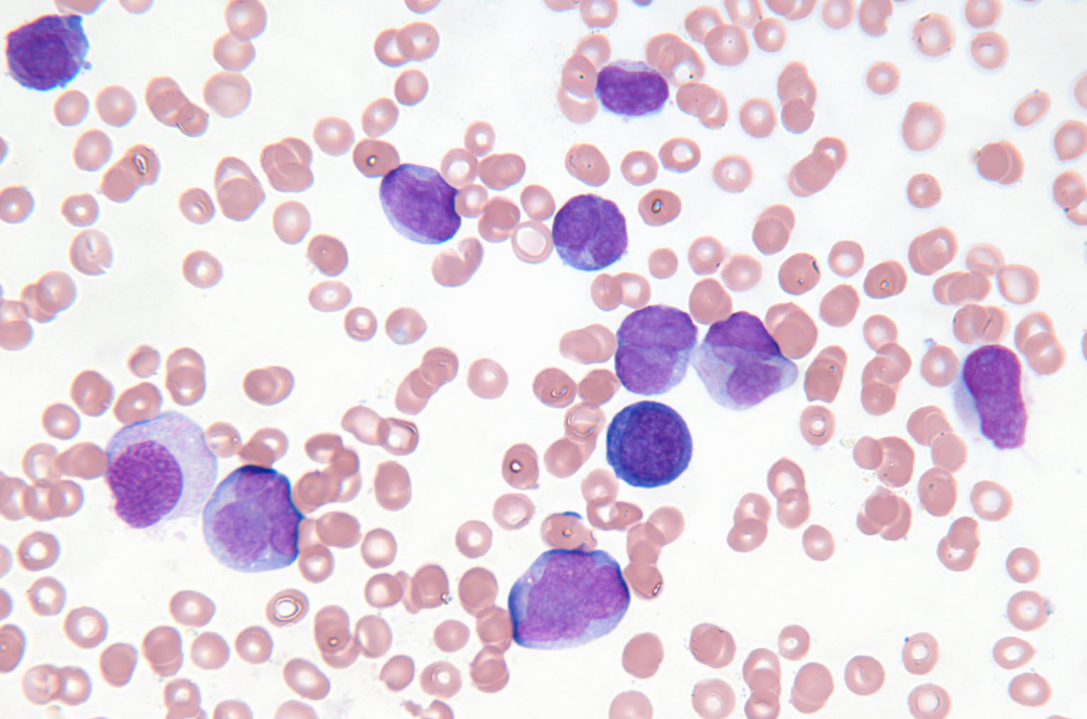 White Blood Cells May Play Role In Spread Of Cancer HuffPost