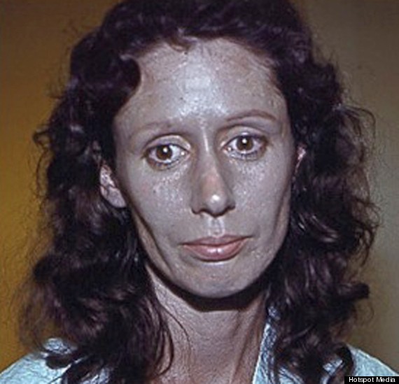 Woman's Use Of Nose Drops Turned Her Skin Silver - Now She's Trying To ...