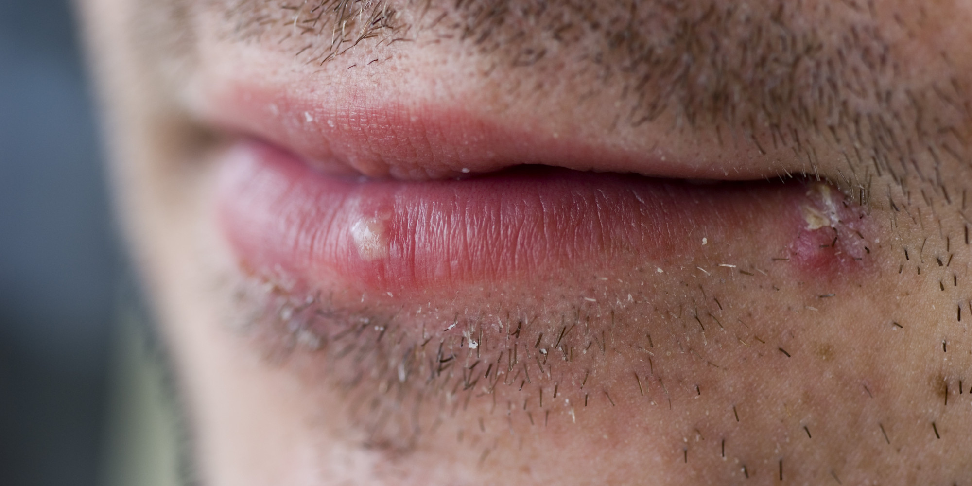 Herpes Virus Could Successfully Treat Skin Cancer Study Suggests HuffPost UK