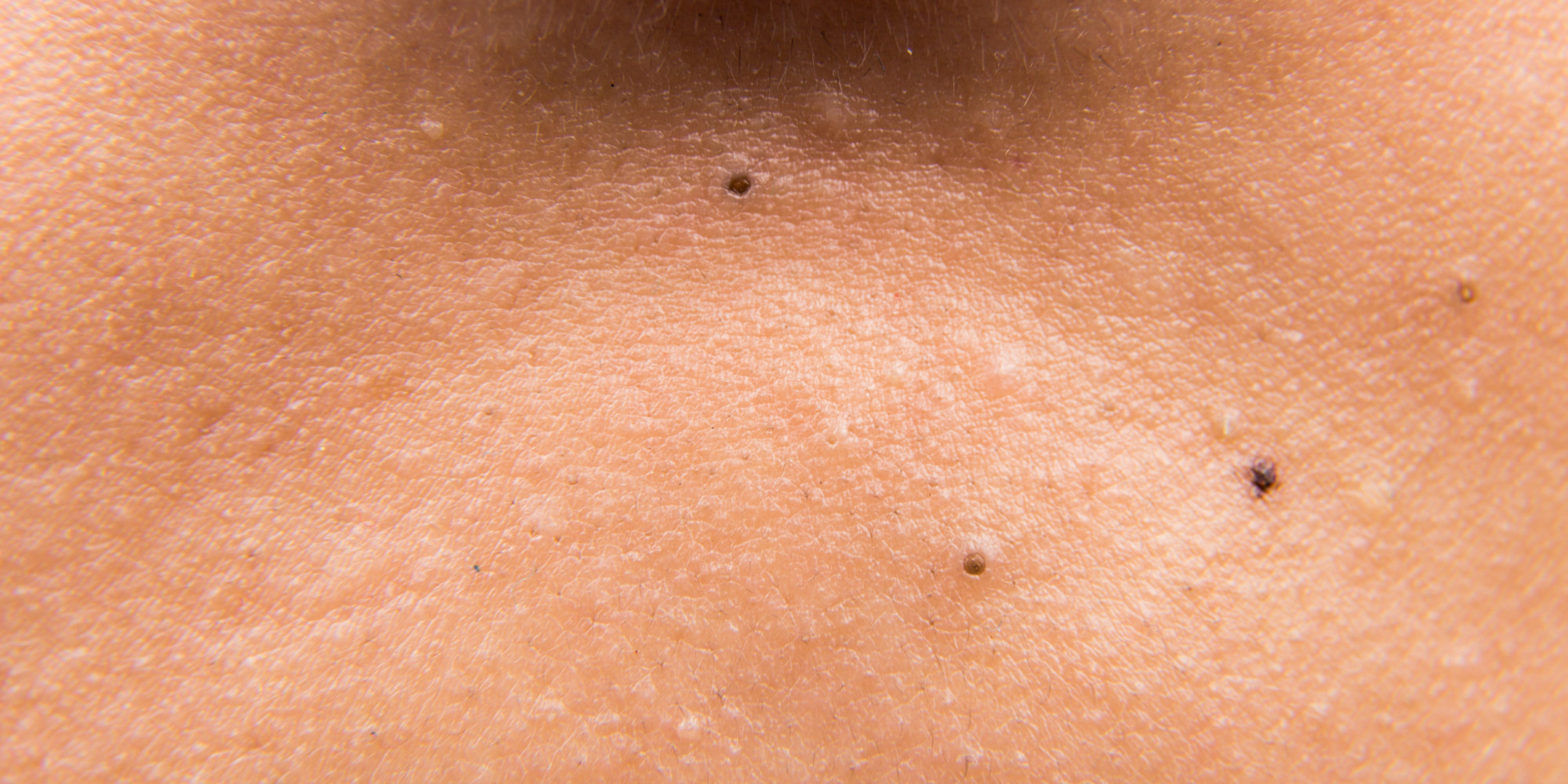 8 Questions You Have About Blackheads Answered