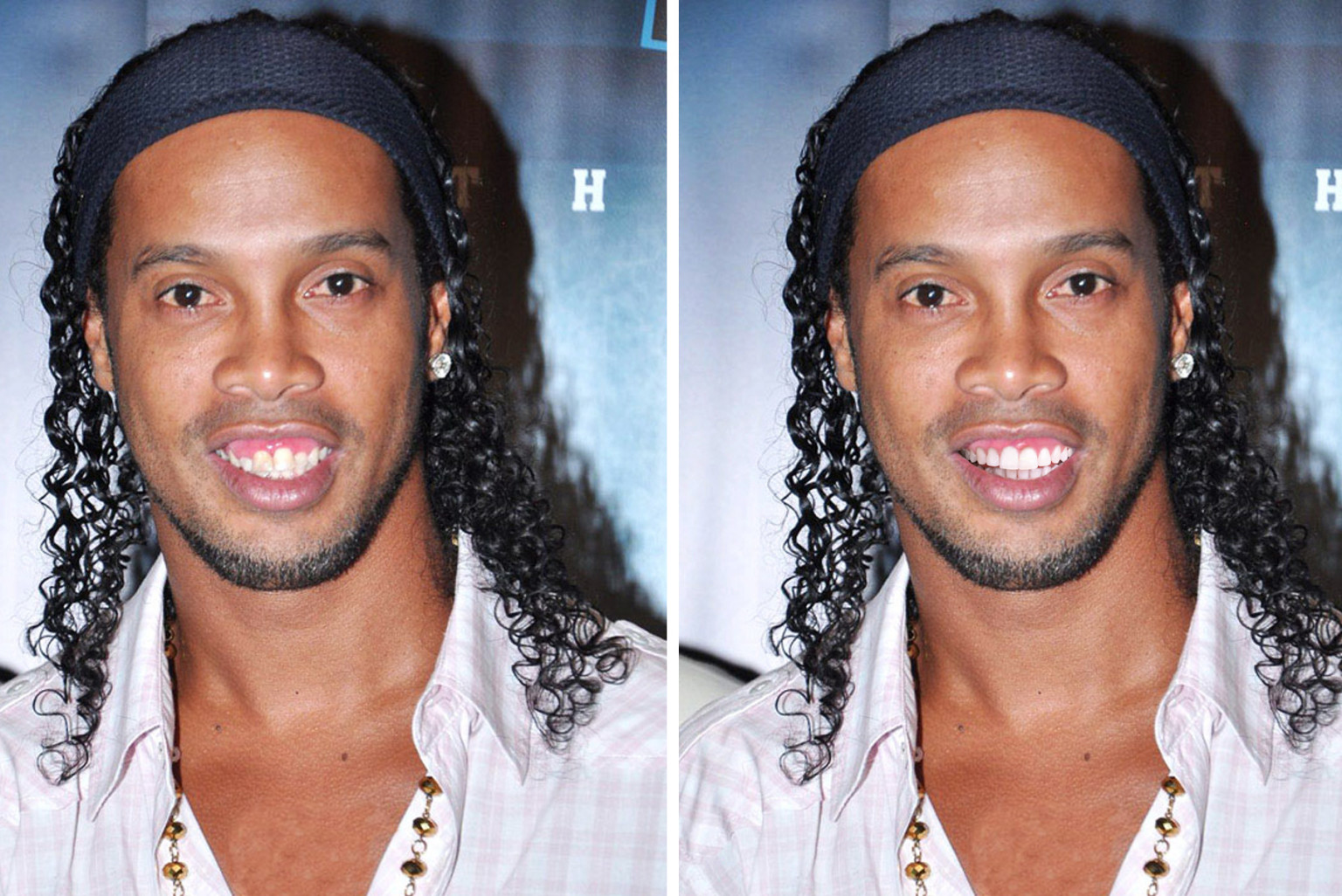Dentes De Ronaldinho
