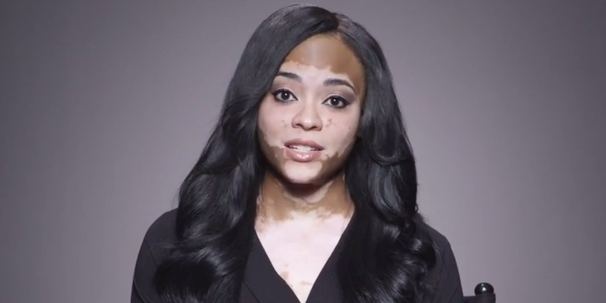 This Woman With Vitiligo Reminds Us Of What 'Beautiful' Really Means ...
