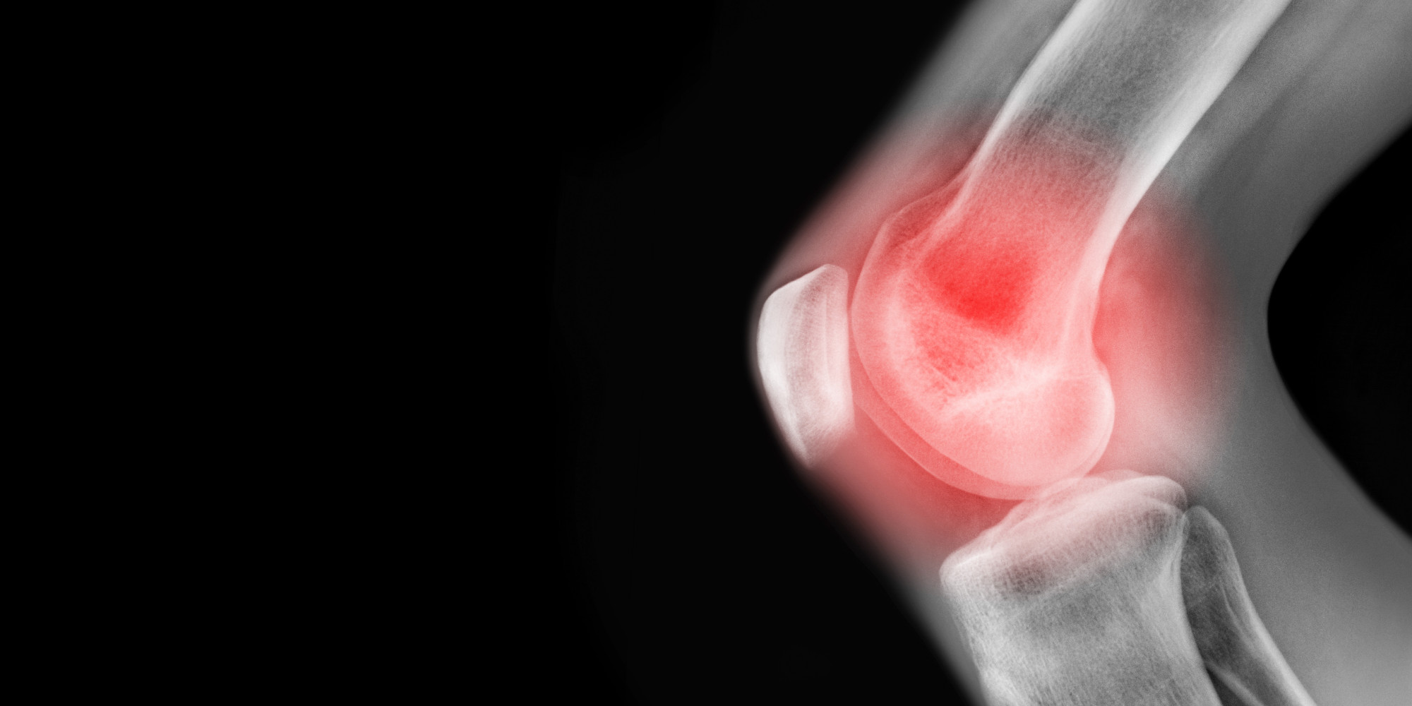 The Worst Sports Injuries (And How To Avoid Them) | HuffPost
