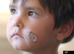 Gross Pathology Of The Skin 4 Bacterial Disease Youtube