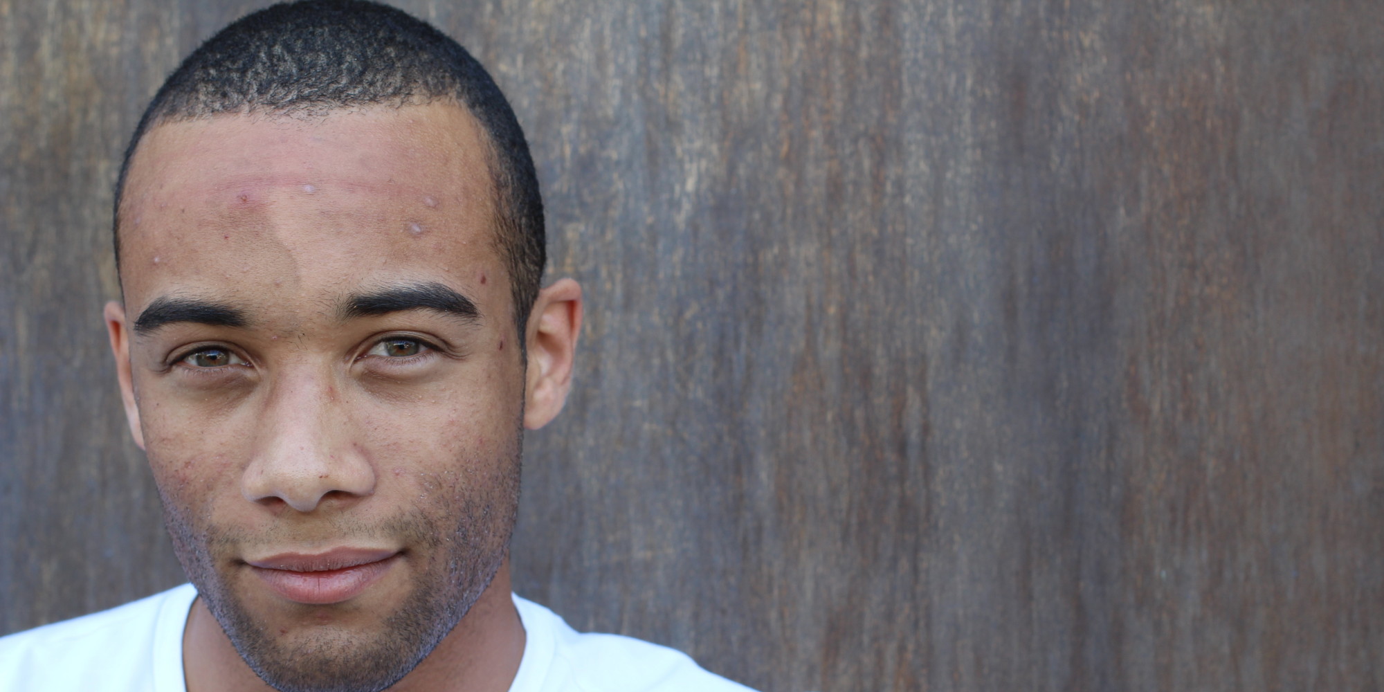 There's Finally An Acne Laser Treatment For People With Dark Skin