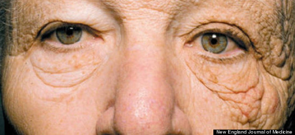 Bill McElligott, Delivery Truck Driver, Has Severe Sun Damage On One ...