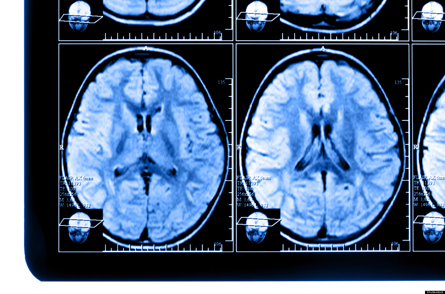 Deep Brain Stimulation Implant Tested In Alzheimer's Trial | HuffPost